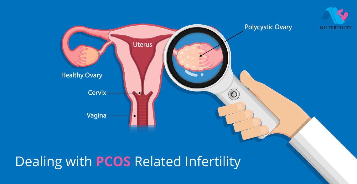 Polycystic Ovary Syndrome: Forestall And The Impending Future Ahead